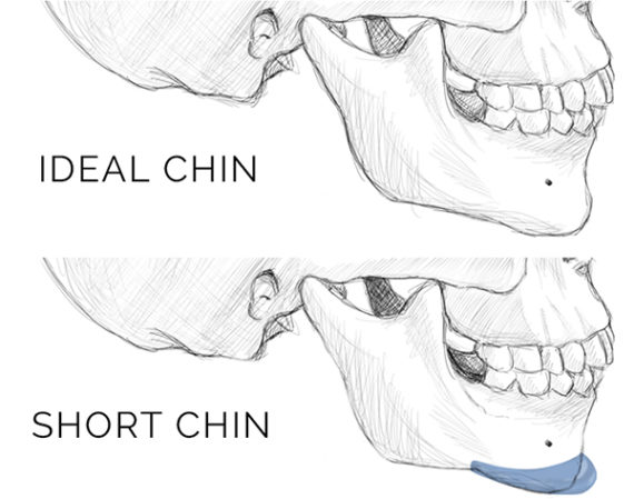 Chin Augmentation Chicago, IL | Chin implants | Mentoplasty
