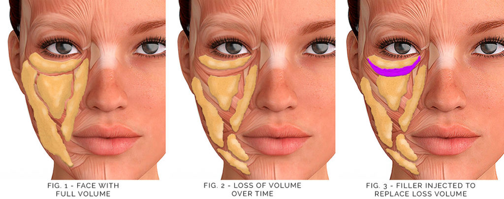 Under Eye Filler | Chicago, IL | Dr. Anil Shah