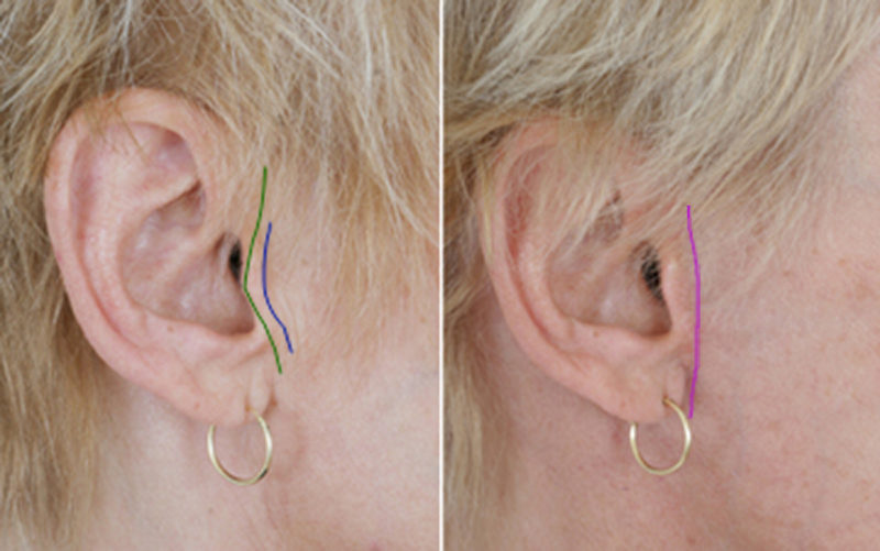 Facelift Scars - Dr. Anil Shah, Facial Plastic Surgeon | Chicago, IL