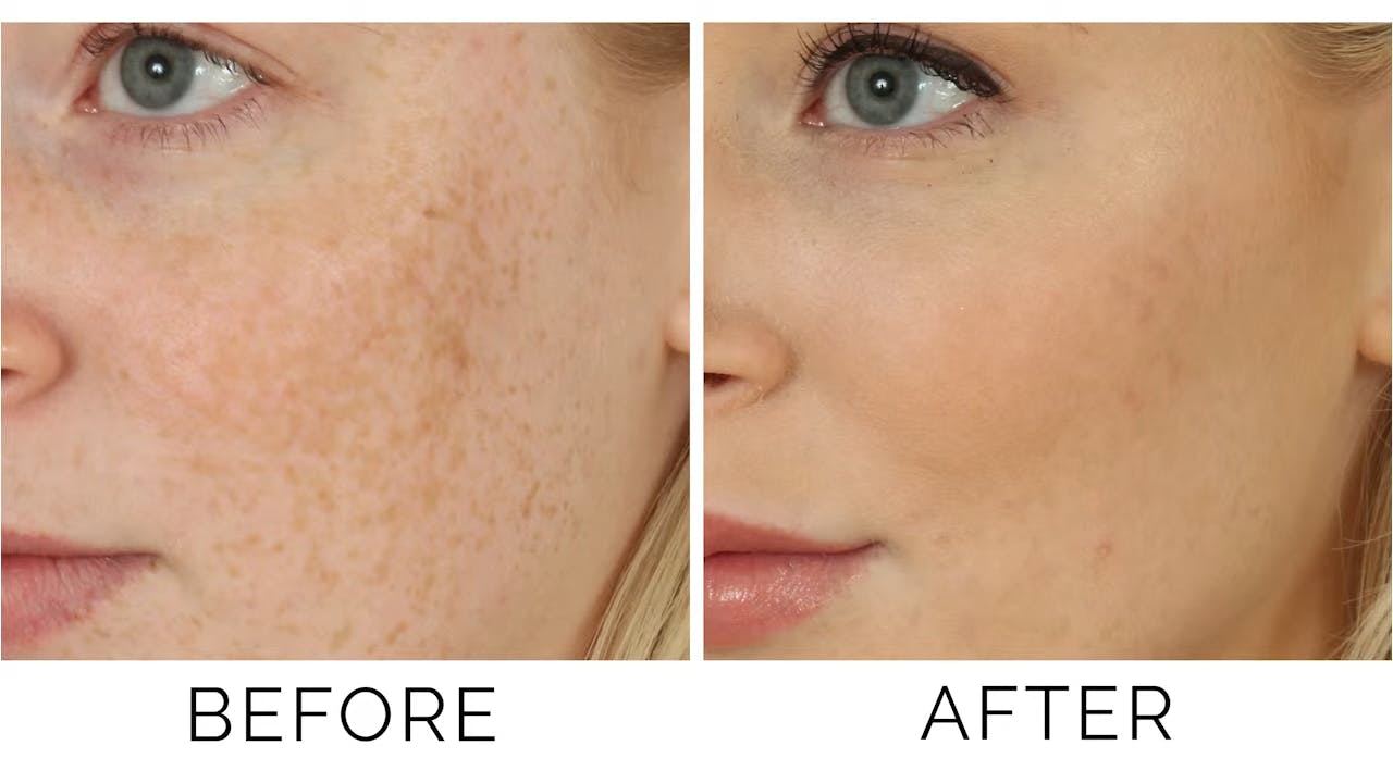 Hyperpigmentation | Chicago, IL | Dr. Anil Shah