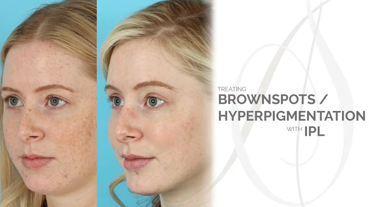 IPL Laser | Chicago, IL | Dr. Anil Shah