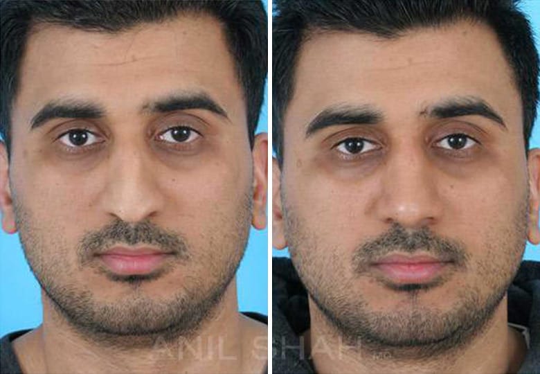 Ethnic Rhinoplasty | Chicago, IL | Dr. Anil Shah