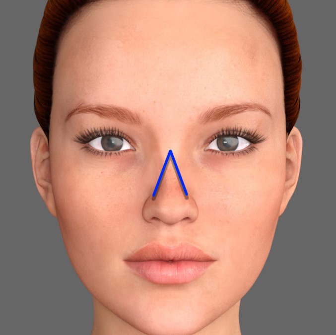 Dorsal Hump Removal | Chicago, IL | Dr. Anil Shah