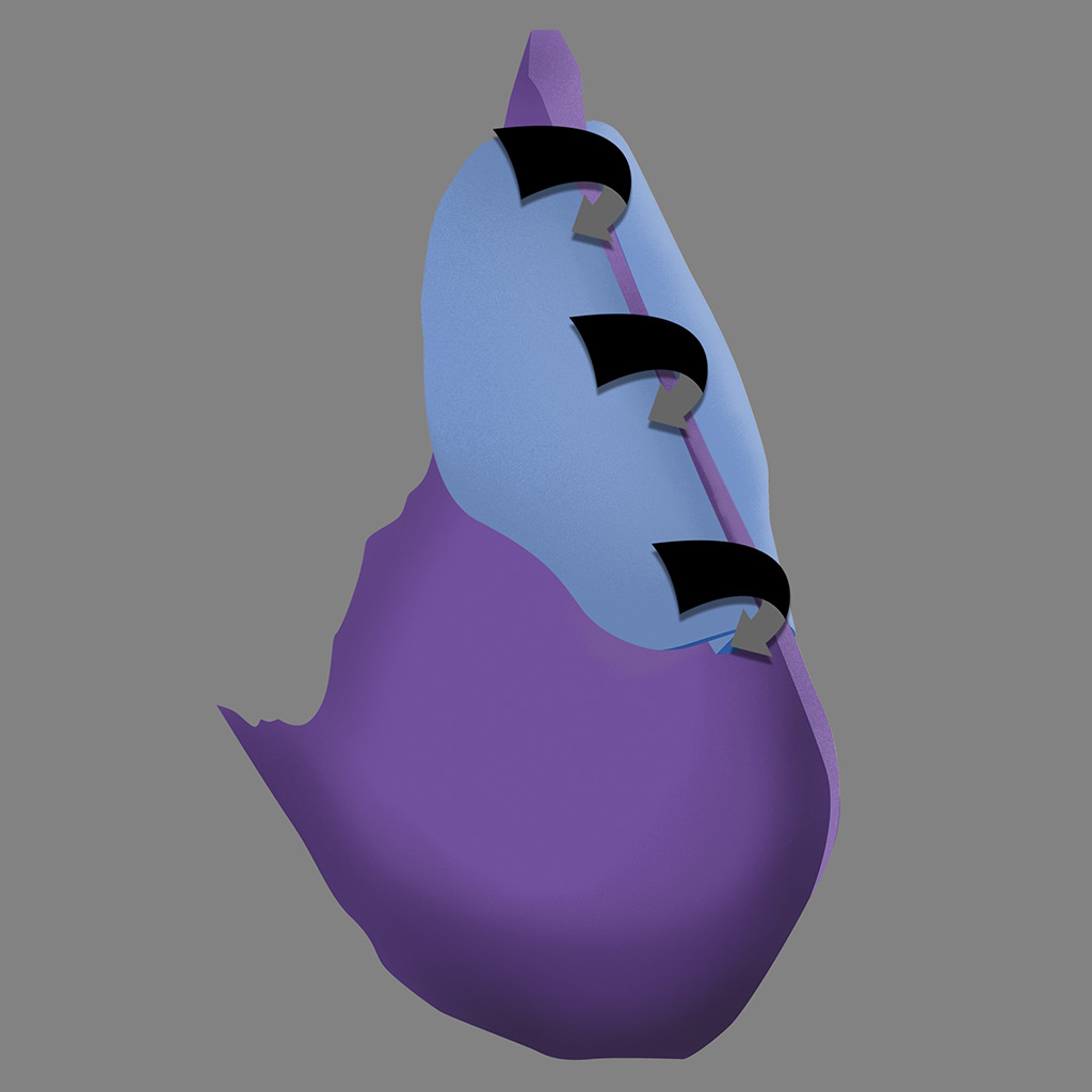 Dorsal Hump Removal | Chicago, IL | Dr. Anil Shah