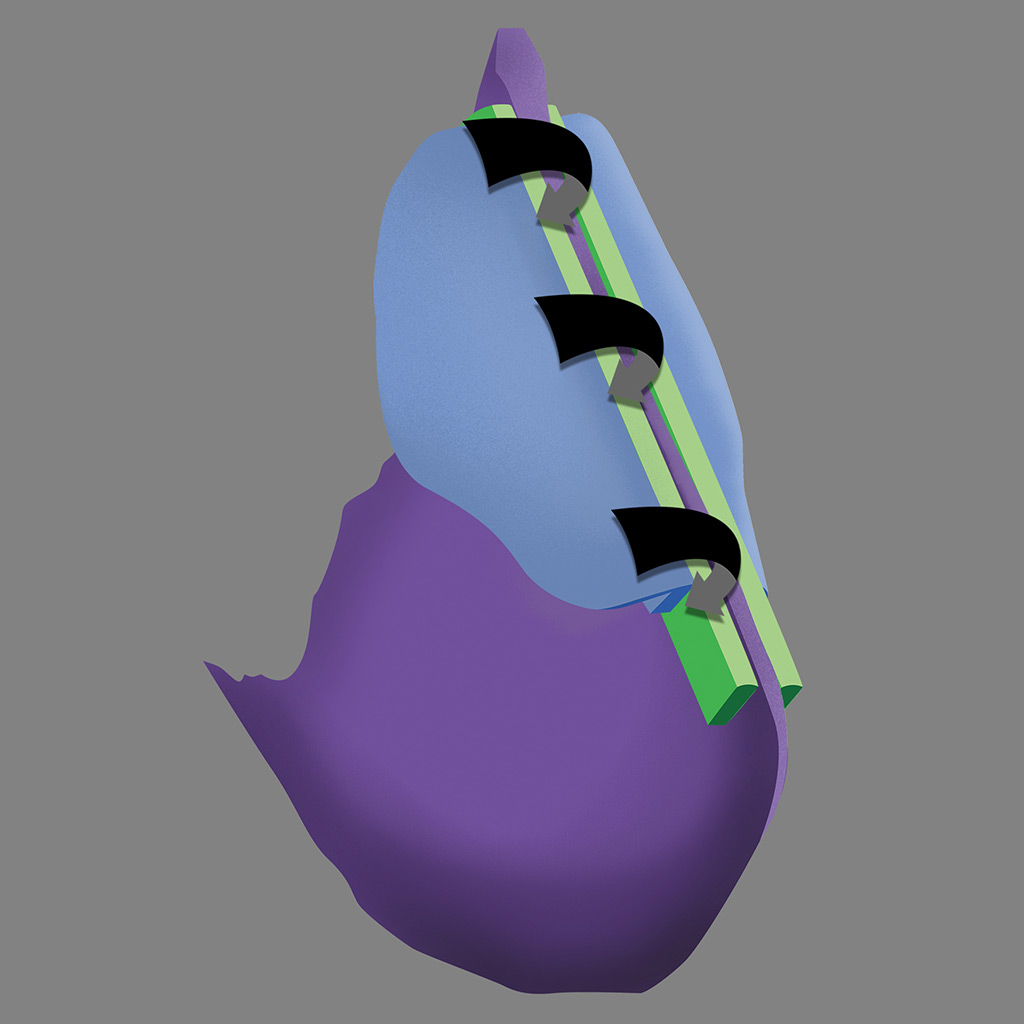 Dorsal Hump Removal | Chicago, IL | Dr. Anil Shah