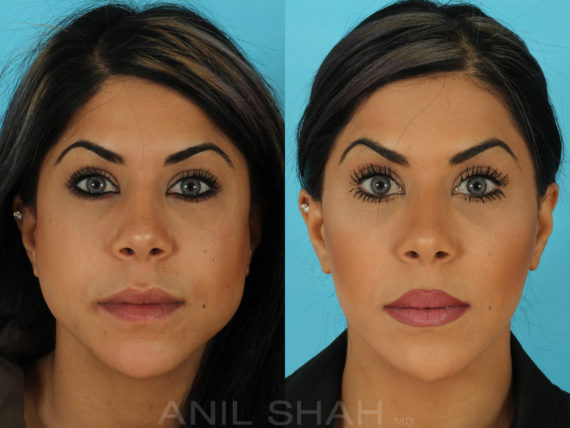 BOTOX For TMJ Disorders | Chicago, IL | Dr. Anil Shah