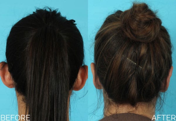 Otoplasty Chicago, IL | Ear Surgery in Chicago | Dr. Anil Shah