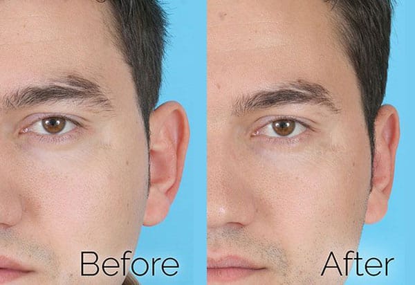 Otoplasty Chicago, IL | Ear Surgery in Chicago | Dr. Anil Shah