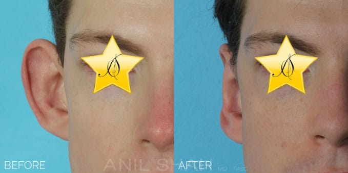 Otoplasty Chicago, IL | Ear Surgery in Chicago | Dr. Anil Shah