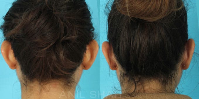 Otoplasty Chicago, IL | Ear Surgery in Chicago | Dr. Anil Shah
