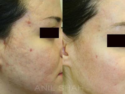 Acne Scars Before & After Photos | Dr. Anil Shah