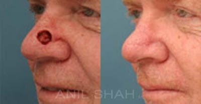 Facial Reconstruction Before & After Photos | Dr. Anil Shah