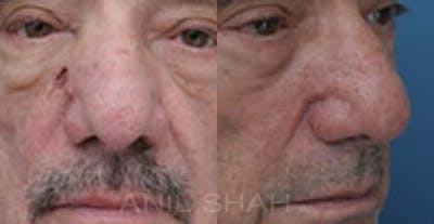 Facial Reconstruction Before & After Photos | Dr. Anil Shah