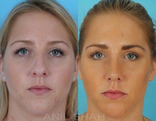 Rhinoplasty Chicago, IL | Nose Job Expert | Dr. Anil Shah