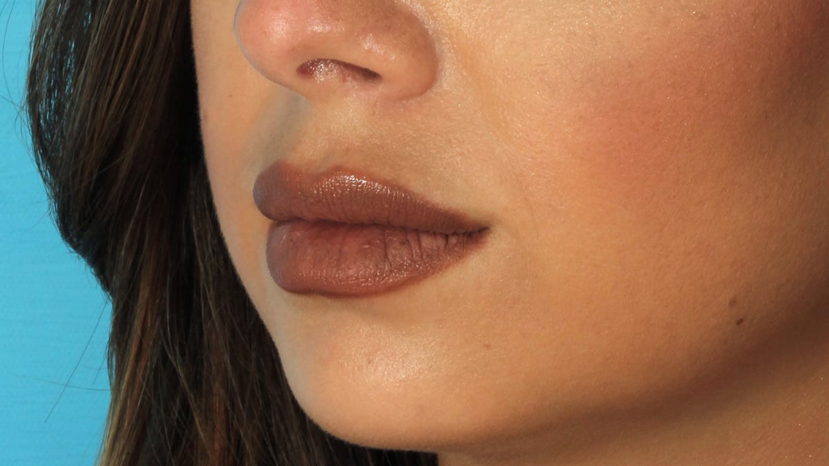 Lip Augmentation | Chicago, IL | Lip Injections | Dr. Anil Shah