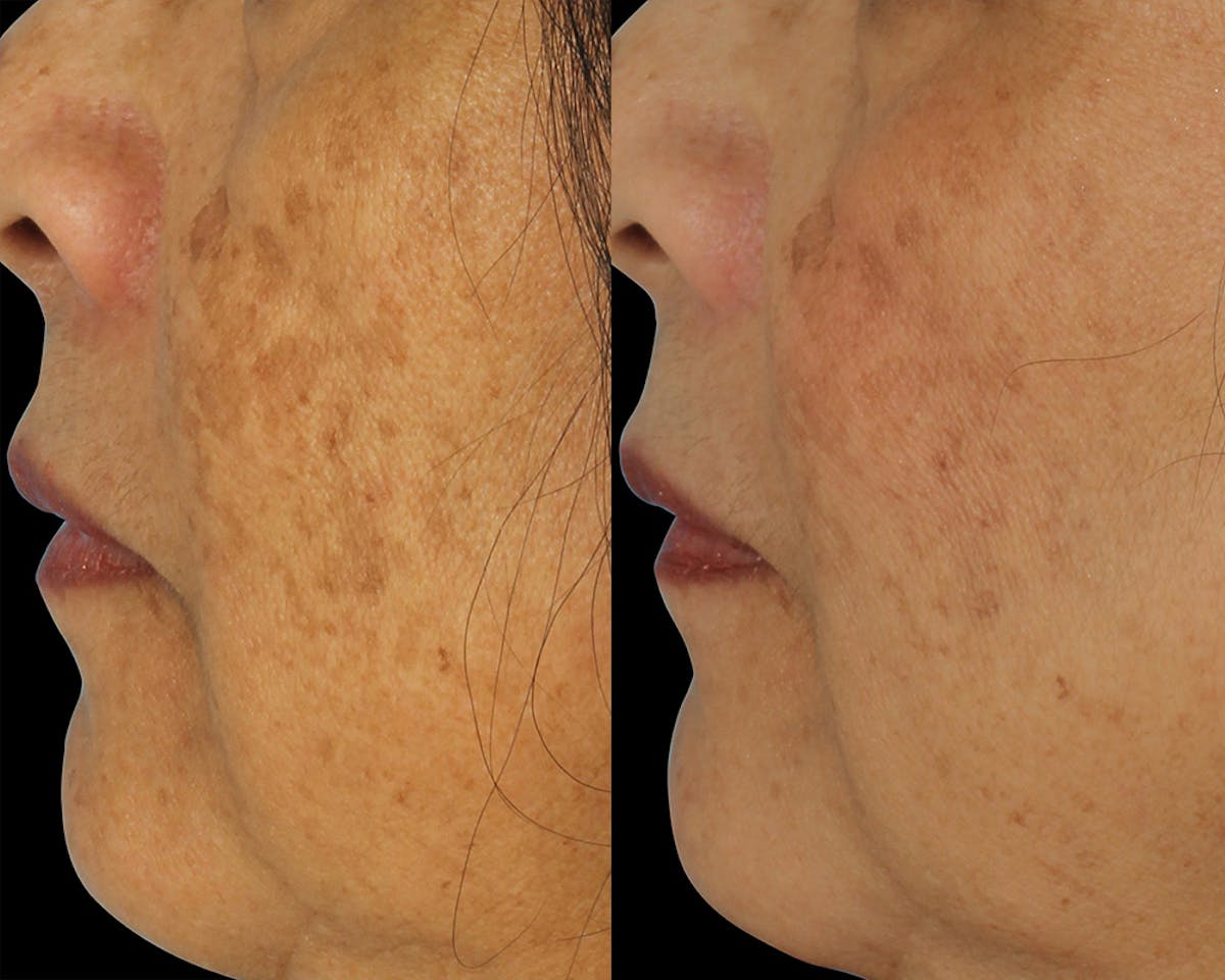 Patient 283461 | Hyperpigmentation Before & After Photos | Dr. Anil Shah