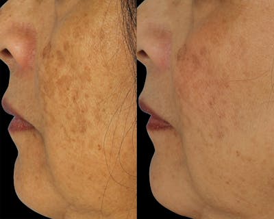 Hyperpigmentation Before & After Photos | Dr. Anil Shah