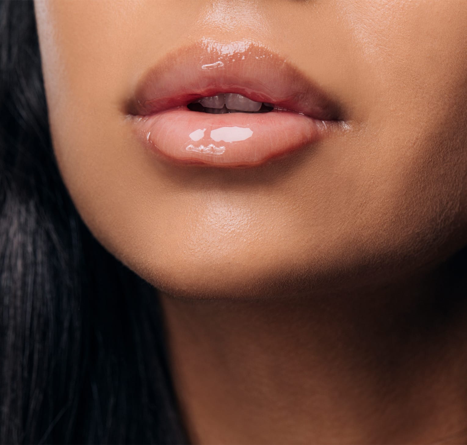 Revanesse Lips In Fort Lauderdale Dr Lisa J Learn