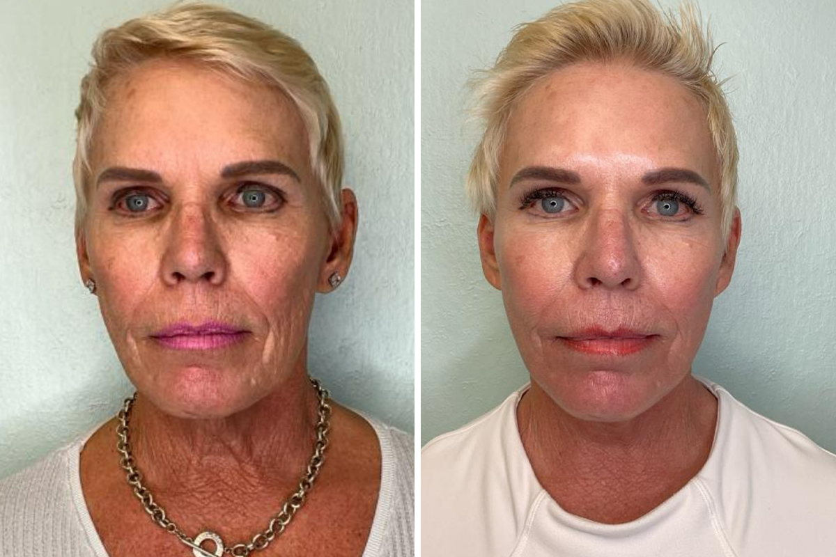 Patient 176795220 | Modified Facelift Before & After Photos | Dr. Lisa ...
