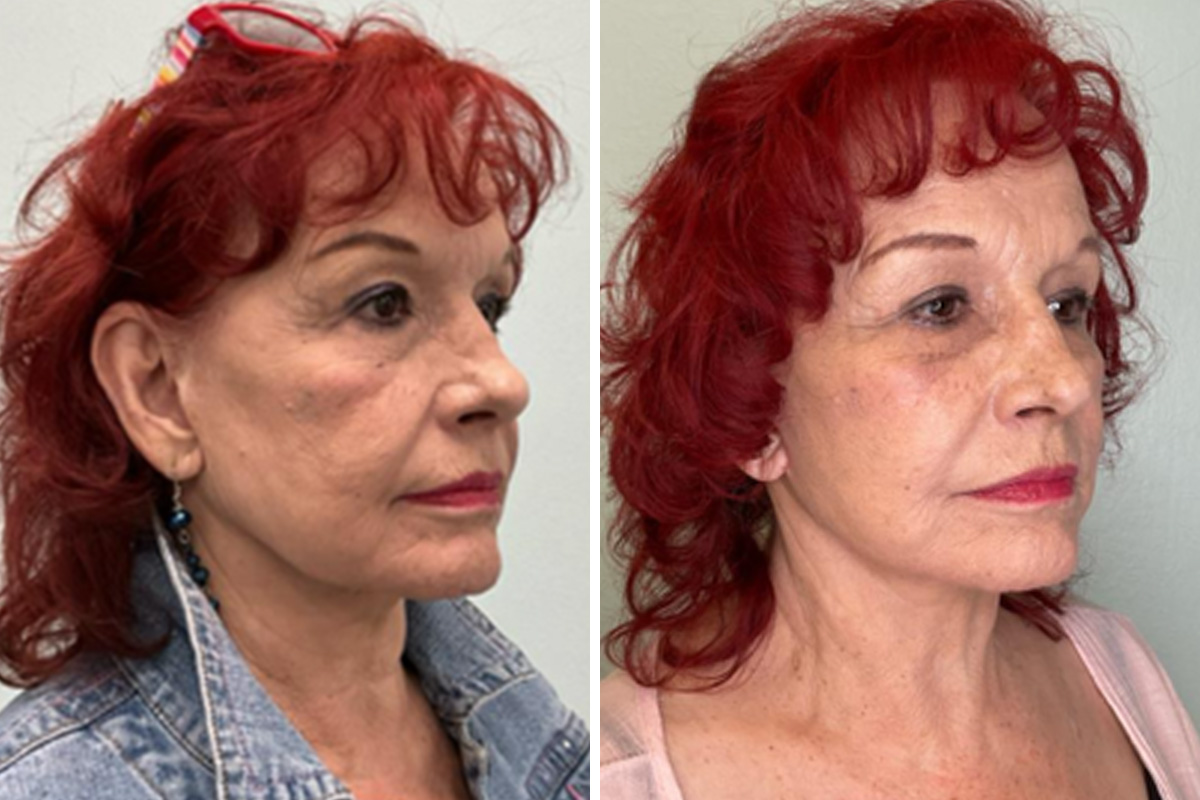 Patient 198576 | Modified Neck Lift Before & After Photos | Dr. Lisa Learn