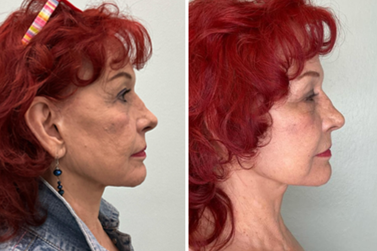 Patient 198576 | Modified Neck Lift Before & After Photos | Dr. Lisa Learn