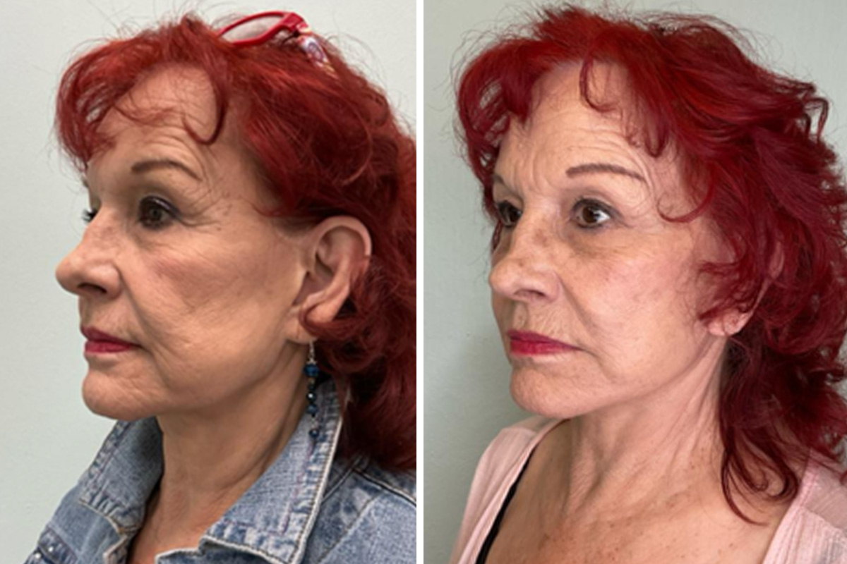 Patient 198576 | Modified Neck Lift Before & After Photos | Dr. Lisa Learn
