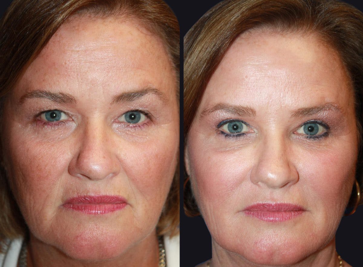 Patient 177927757 Chemical Peel Before And After Photos Boston Center