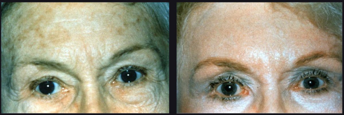 Patient 177927746 Chemical Peel Before And After Photos Boston Center