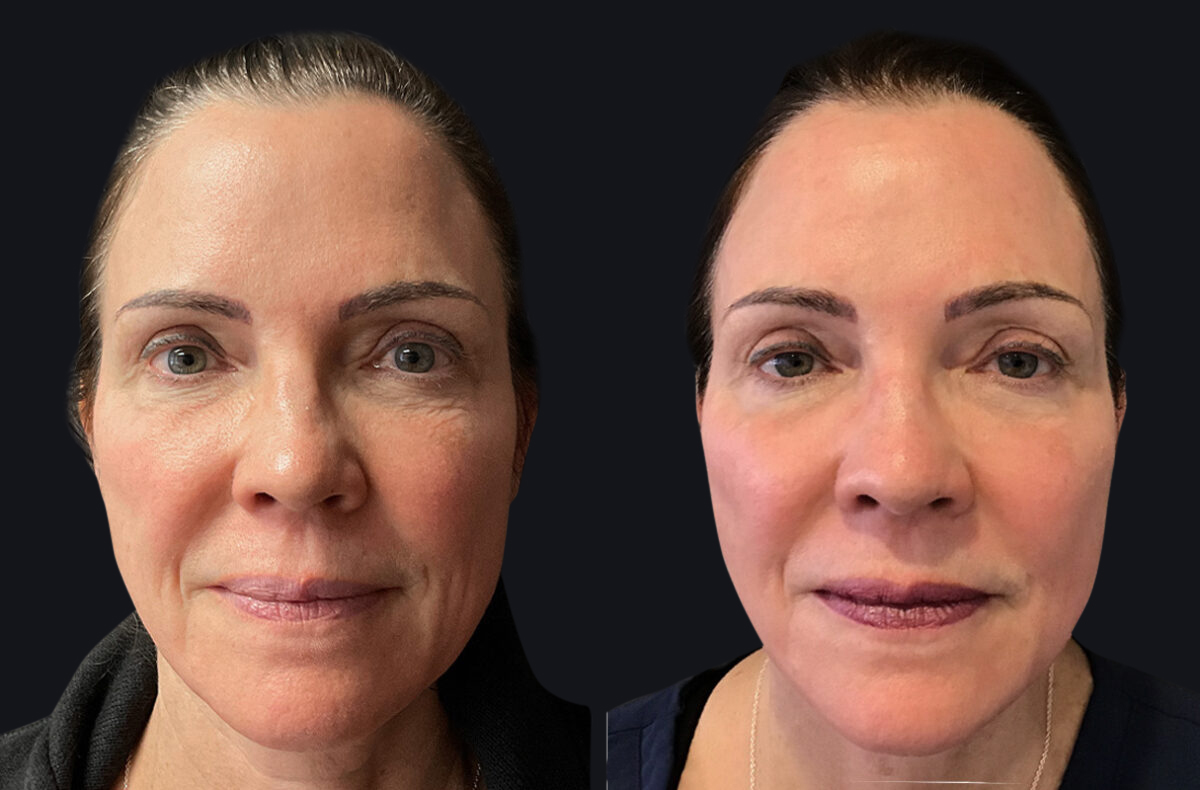 CO2 Laser Resurfacing - Boston Plastic Surgeon - Dr. Tandon
