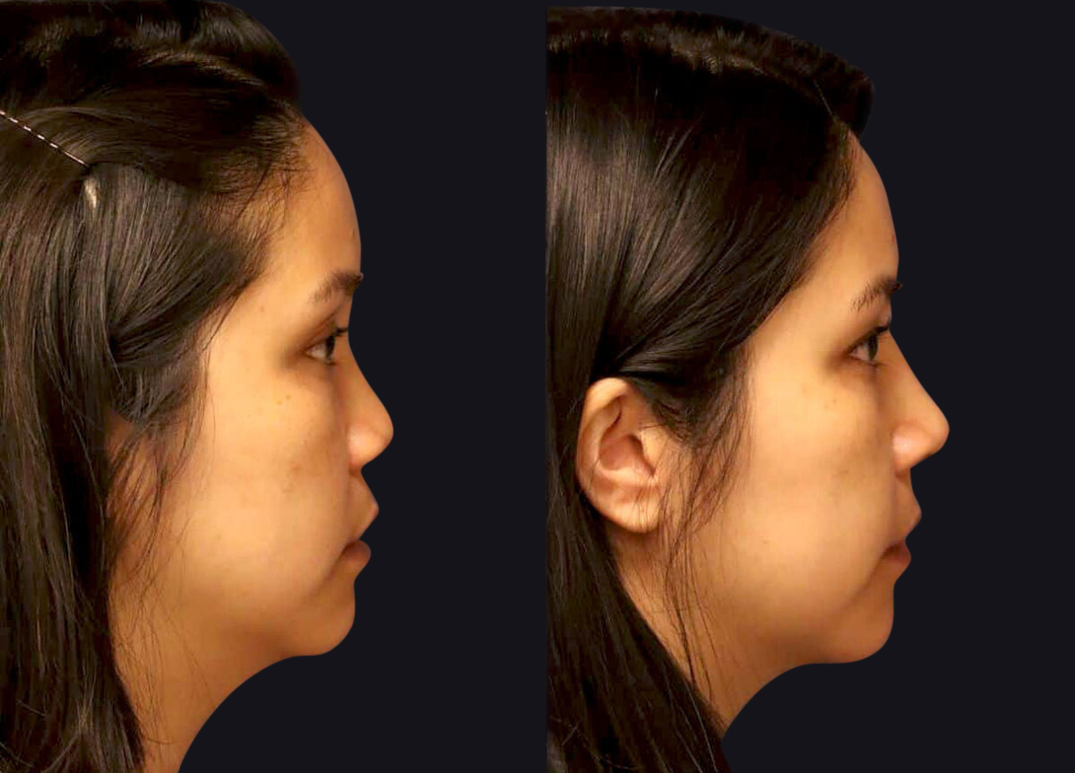 Patient 177905861 | Rhinoplasty Before & After Photos | Boston Center ...