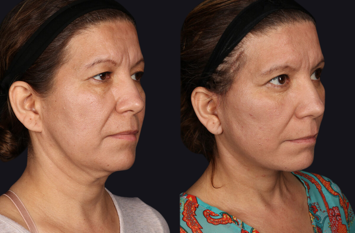 Patient 177619131 | Deep Plane Facelift Before & After Photos | Boston ...
