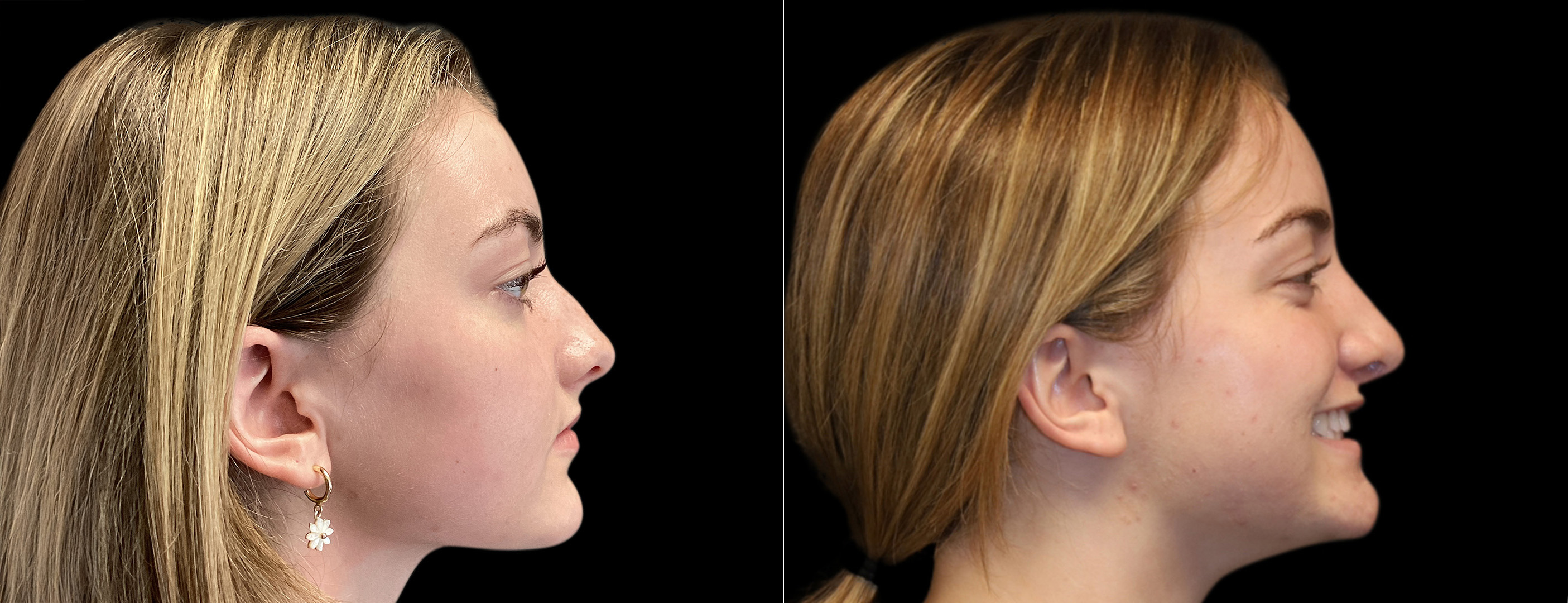Rhinoplasty in Boston, MA | Boston Center for Plastic Surgery