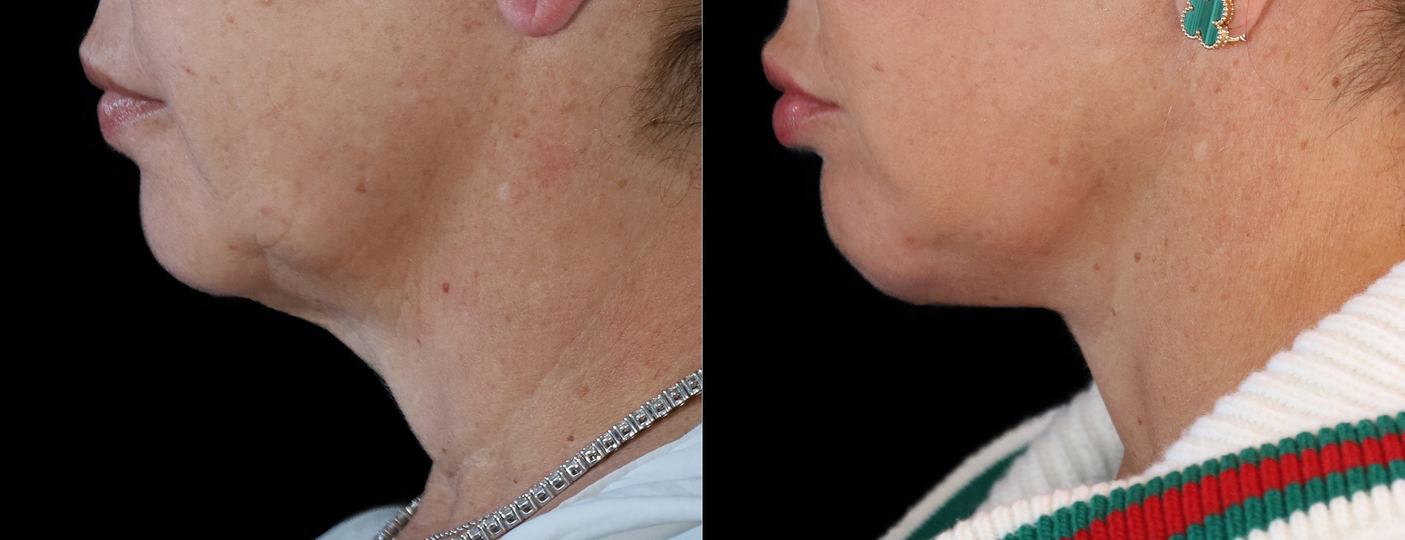 Deep Plane Facelift in Boston, MA | Boston Plastic Surgeon