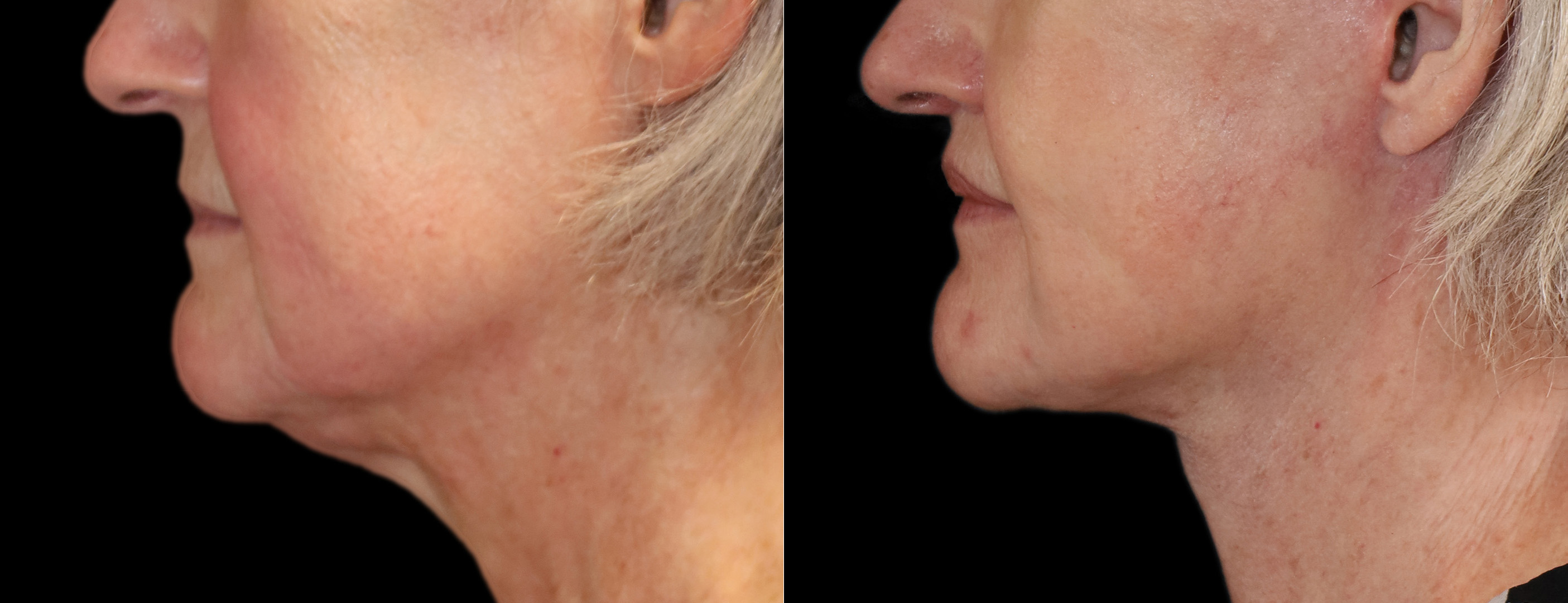 Deep Neck Lift Boston | Boston Center for Plastic Surgery