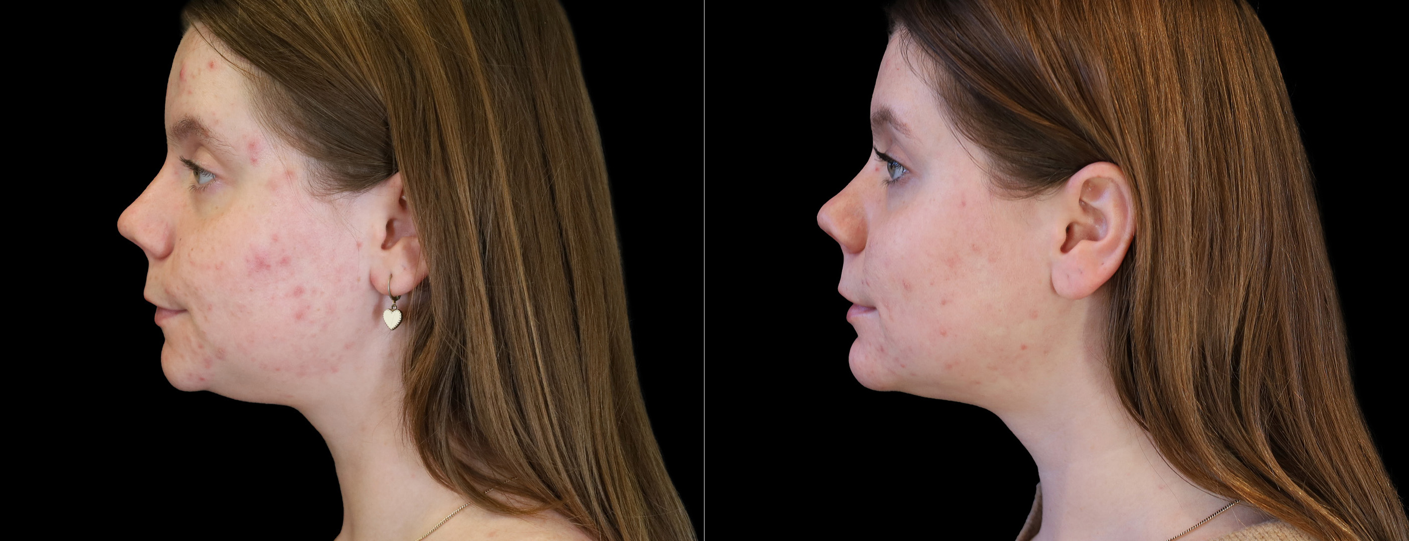 Neck Liposuction Boston, MA | Submental Lipo | Brookline