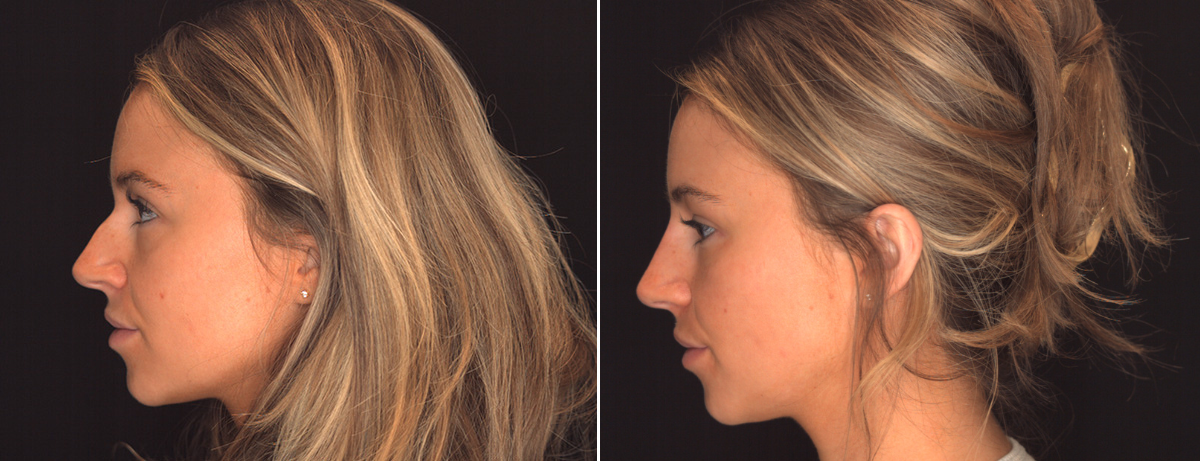 Patient 263491 | Non Surgical Rhinoplasty Before & After Photos ...