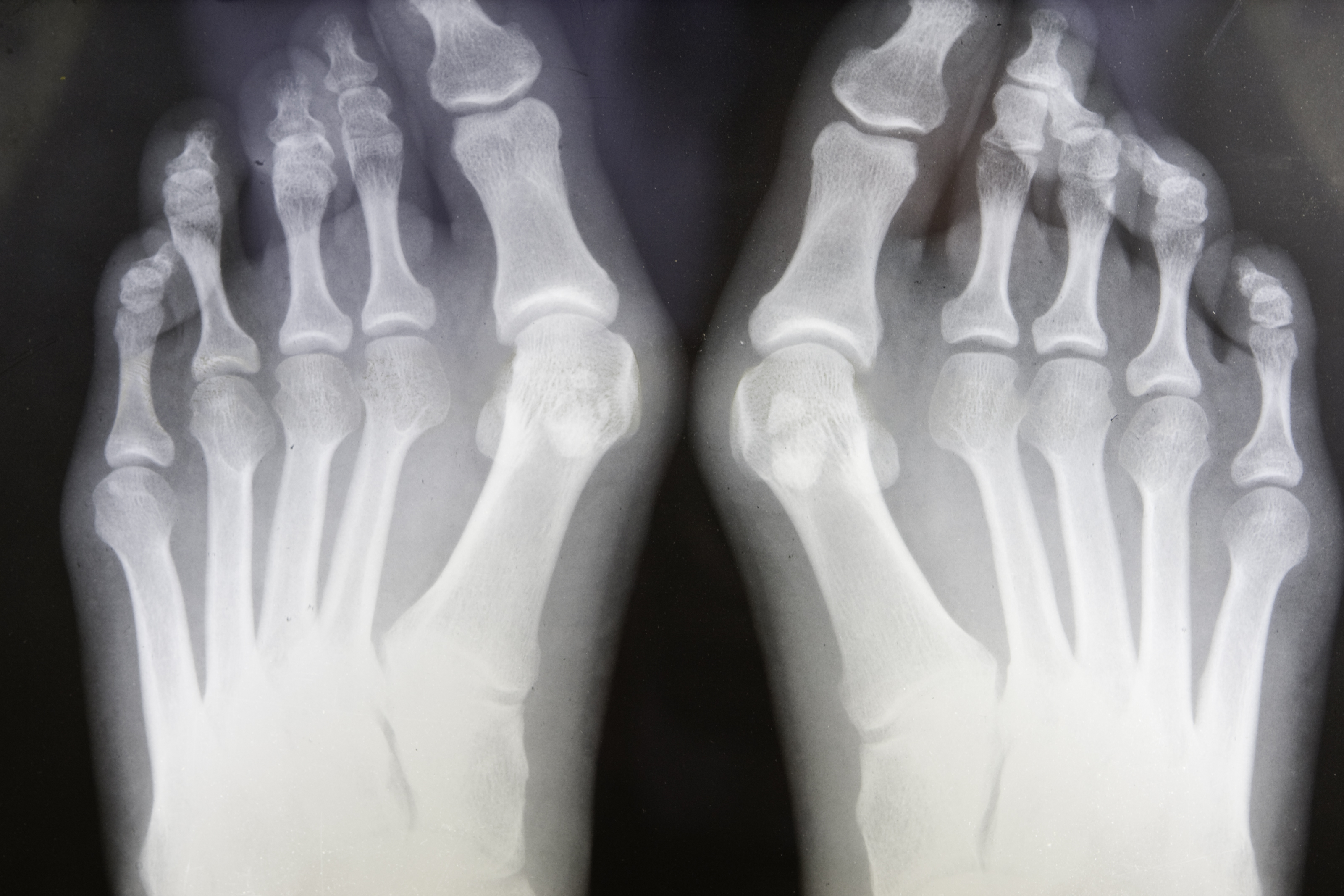 Bunions (Hallux Valgus) | Premier Orthopaedic Associates