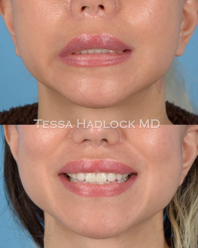 Facial Nerve Repair/Reinnervation Before & After Photos | Hadlock ...