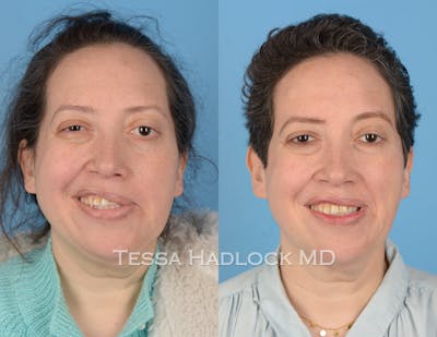 Gracilis Before & After Photos | Hadlock Facial Plastic Surgery