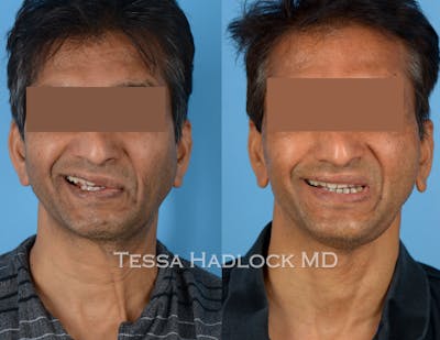 Gracilis Before & After Photos | Hadlock Facial Plastic Surgery