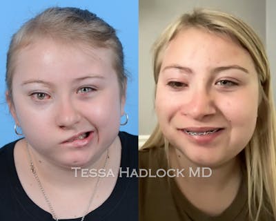 Gracilis Before & After Photos | Hadlock Facial Plastic Surgery