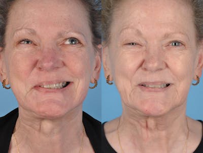 Facial Nerve Repair/Reinnervation Before & After Photos | Hadlock ...