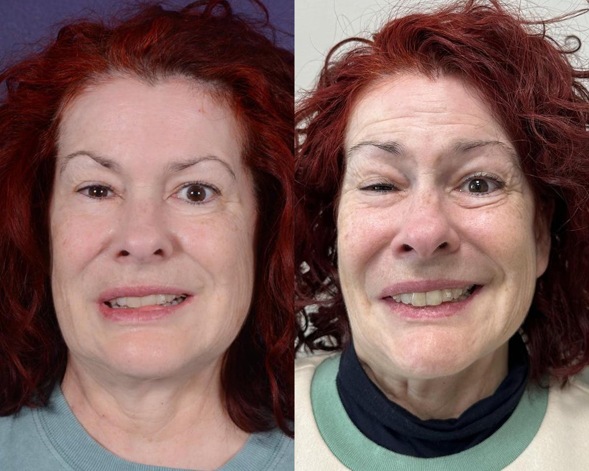 Patient 114582 | Muscle Resection Before & After Photos | Hadlock ...