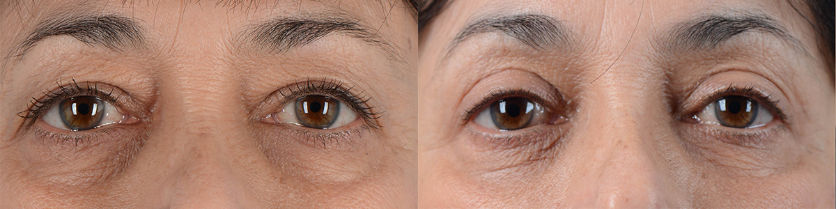 Blepharoplasty Before & After Photos | Hadlock Facial Plastic Surgery