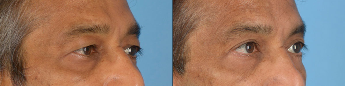 Blepharoplasty Before & After Photos | Hadlock Facial Plastic Surgery