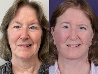 Facial Nerve Repair/Reinnervation Before & After Photos | Hadlock ...