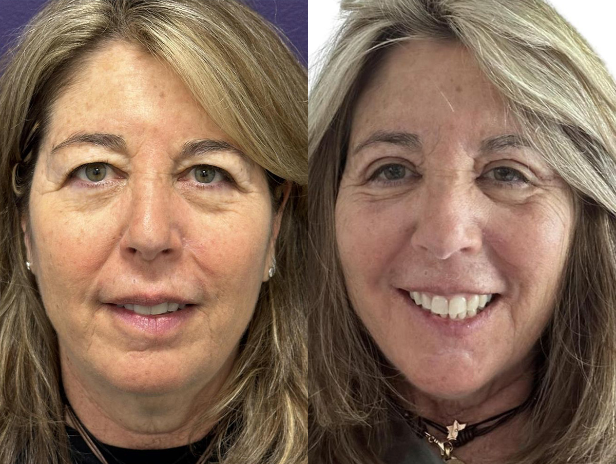 Blepharoplasty Before & After Photos | Hadlock Facial Plastic Surgery