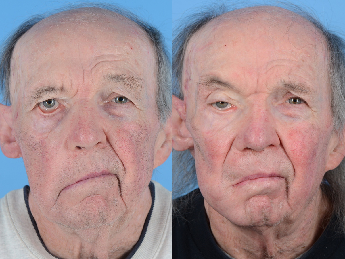 Static Suspension Before & After Photos | Hadlock Facial Plastic Surgery