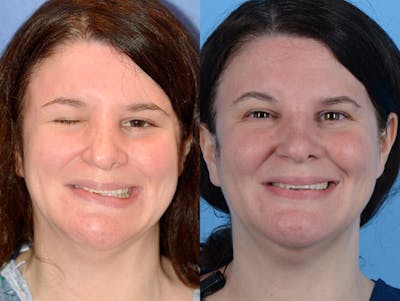 Muscle Resection: DAO, DLI, Ocular Myomectomy, Mentalis Before & After ...