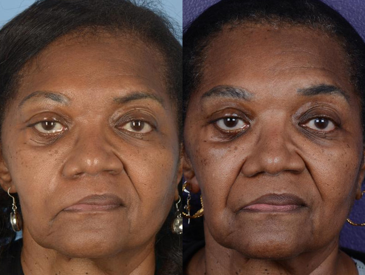 Static Suspension Before & After Photos | Hadlock Facial Plastic Surgery